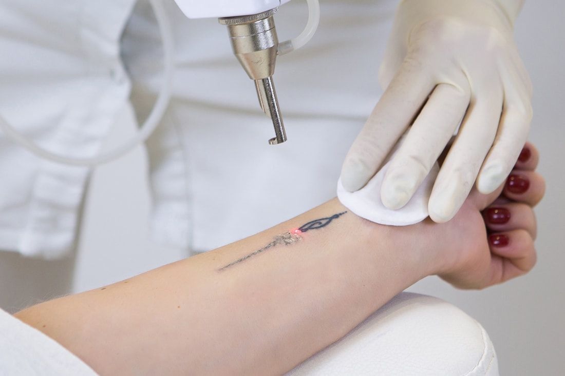 Best Lasers For Tattoo Removal Reviews Guide For 2024